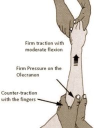 Elbow Dislocation • LITFL • Trauma Library