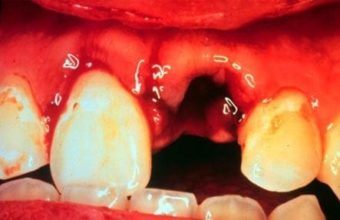 Tooth Avulsion • LITFL • Trauma Library