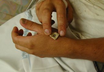 Nail Gun Injuries • LITFL • Trauma Library