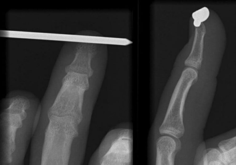 Nail Gun Injuries • LITFL • Trauma Library