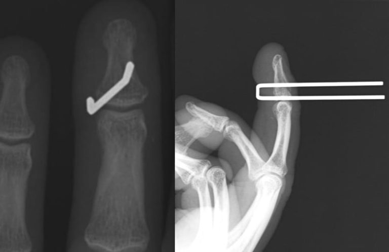 Nail Gun Injuries • LITFL • Trauma Library
