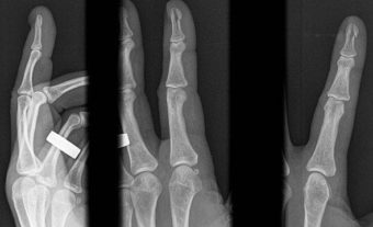 Nail Gun Injuries • LITFL • Trauma Library