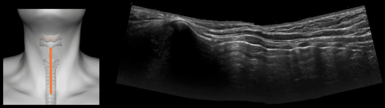 Airway ultrasound longitudinal views • LITFL • Ultrasound Library