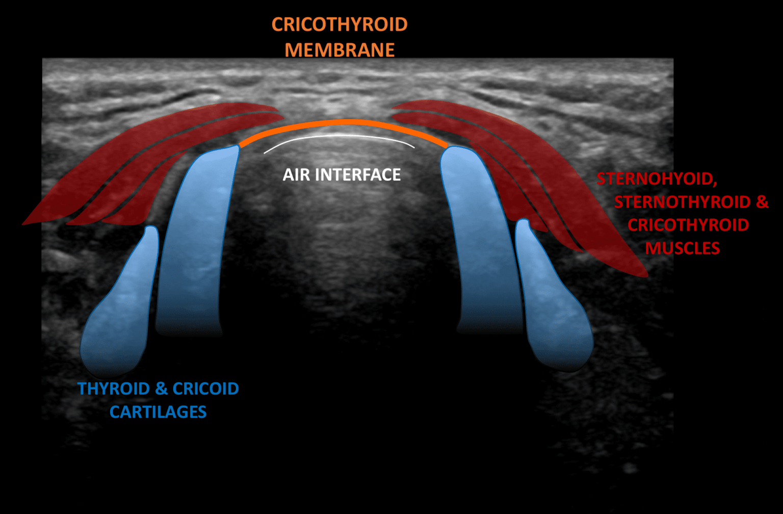 Airway ultrasound transverse views • LITFL • Ultrasound Library