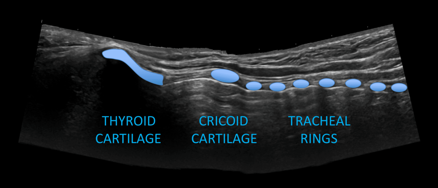 Airway ultrasound longitudinal views • LITFL • Ultrasound Library