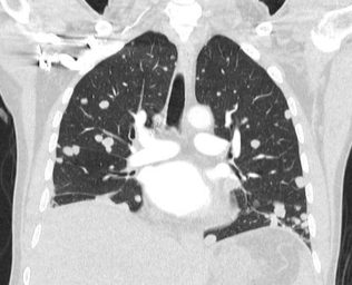 Lung Metastasis Case 002 • LITFL • Lung Ultrasound Library