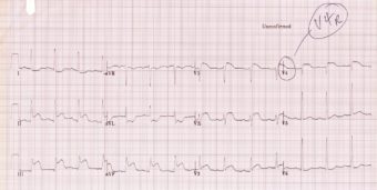 ROSC, hypotension and an ECG exigency • LITFL