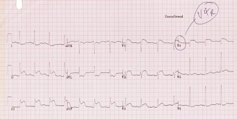 ROSC, hypotension and an ECG exigency • LITFL