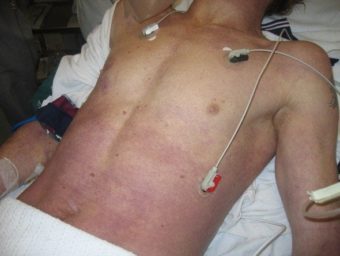 Top 10 pearls for managing anaphylaxis • LITFL