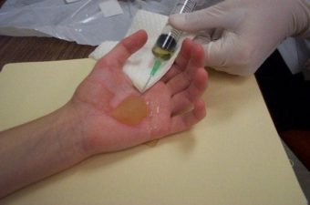 Minor Burn Management • LITFL