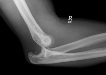 Elbow Dislocation • LITFL • Trauma Library