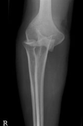 Elbow Dislocation • LITFL • Trauma Library