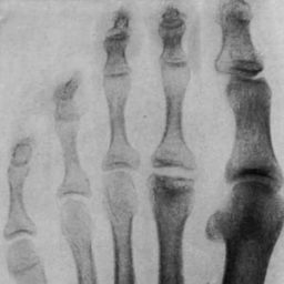 Eponymous Fractures • LITFL • Orthopaedic eponyms