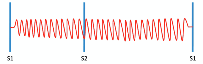 Gibson murmur • LITFL Medical Blog • Medical Eponym Library