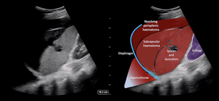 Ultrasound Case 104 • LITFL • POCUS Top 100