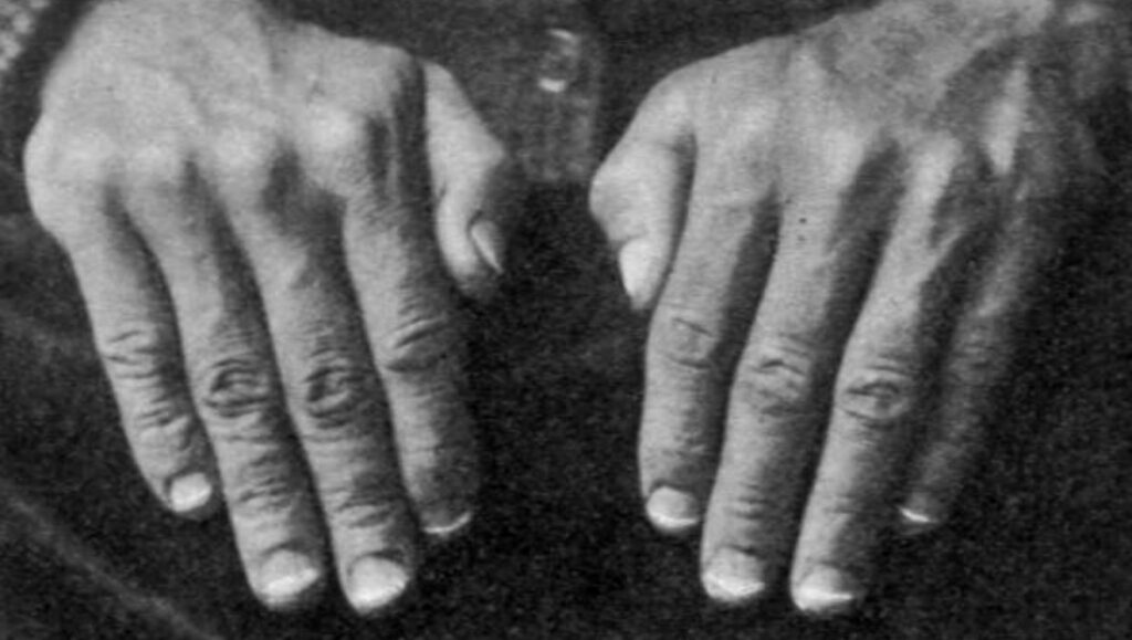 Charles J. Aldrich • LITFL • Medical Eponym Library