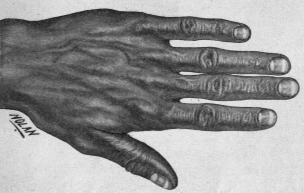 Mees lines • LITFL • Medical Eponym Library