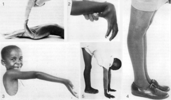 Beighton Score • LITFL • Medical Eponym Library