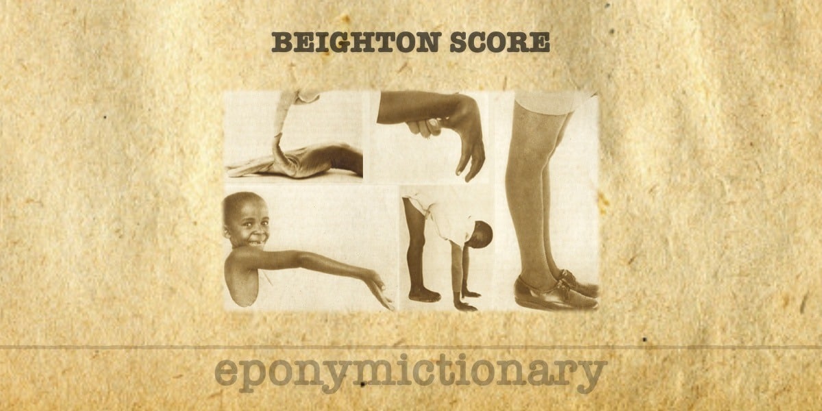 Beighton Score • LITFL • Medical Eponym Library