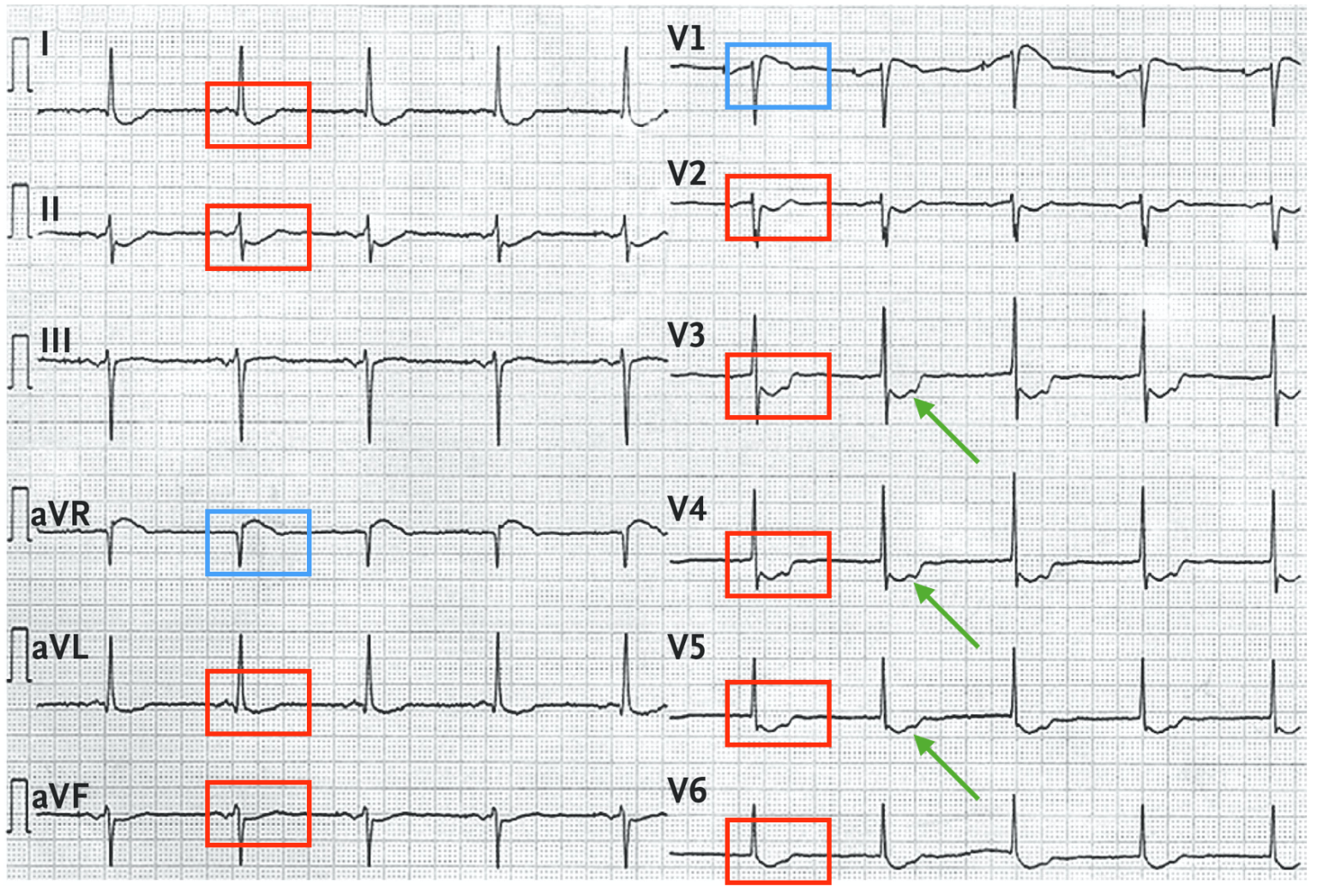 Bundgaard syndrome • LITFL • ECG Library