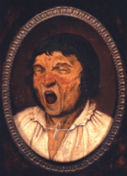 Meige's syndrome • LITFL • Medical Eponym Library