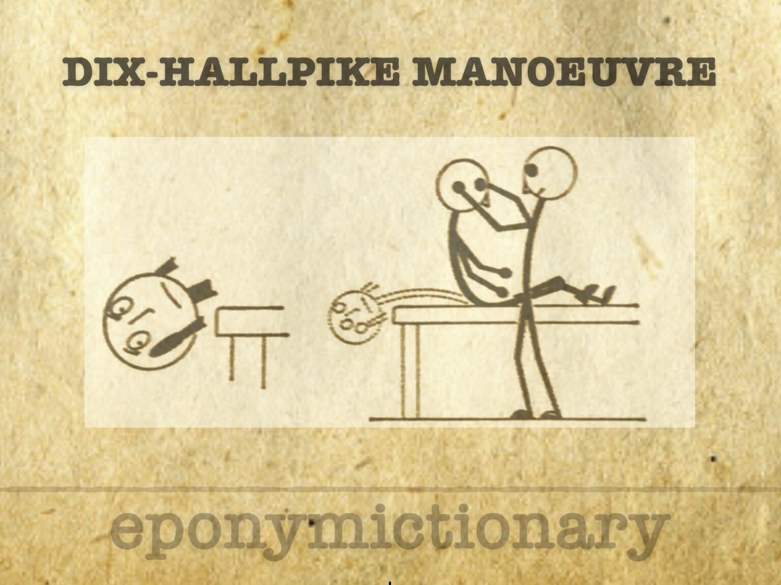 Dix-Hallpike manoeuvre Archives • LITFL