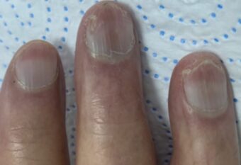 Lindsay nails • LITFL • Medical Eponym Library