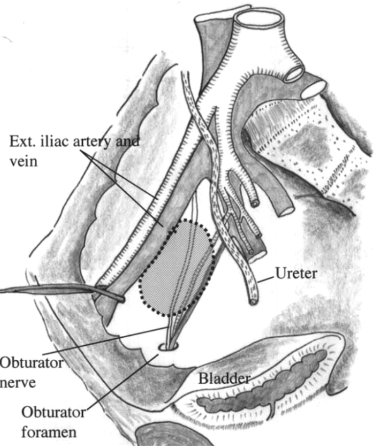 Howship-Romberg sign • LITFL • Medical Eponym Library