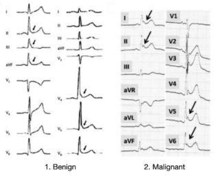 "Benign" Early Repolarization Misnomer • LITFL • ECG Library