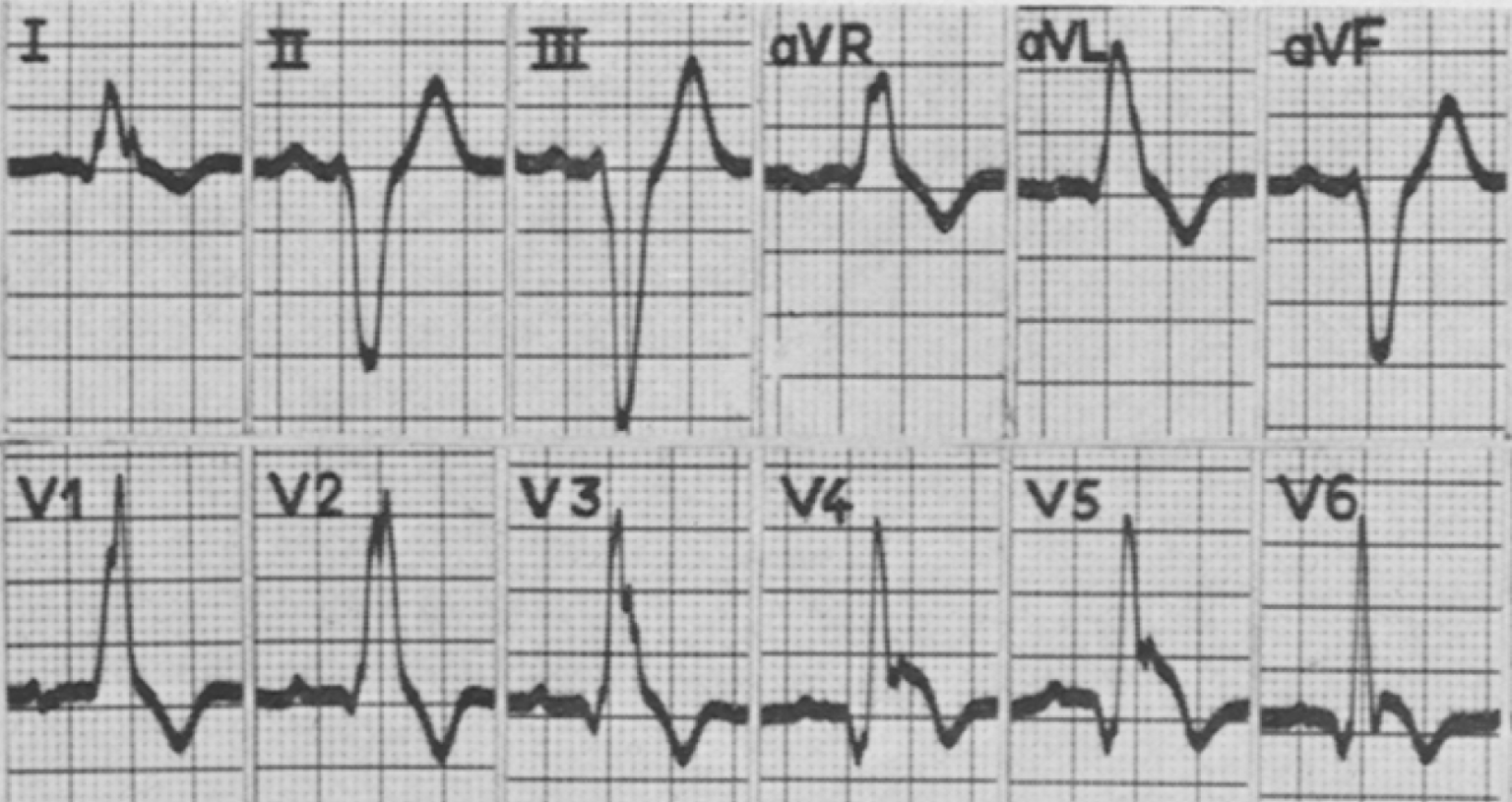 Masquerading Bundle Branch Block (MBBB) • LITFL • ECG Library