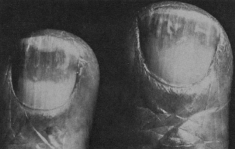 Lindsay nails • LITFL • Medical Eponym Library