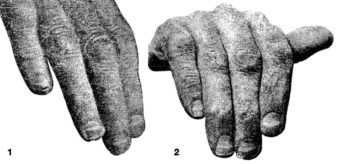 Mees lines • LITFL • Medical Eponym Library