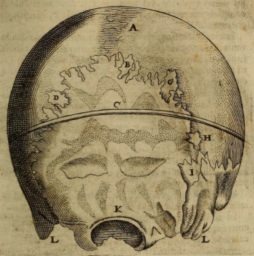 Wormian bones Archives • LITFL