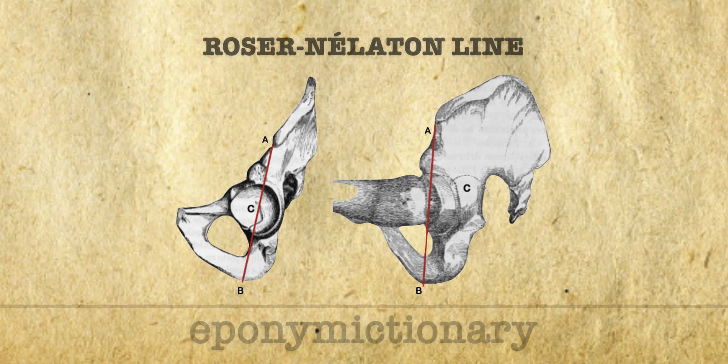 Roser-Nélaton line • LITFL • Medical Eponym Library