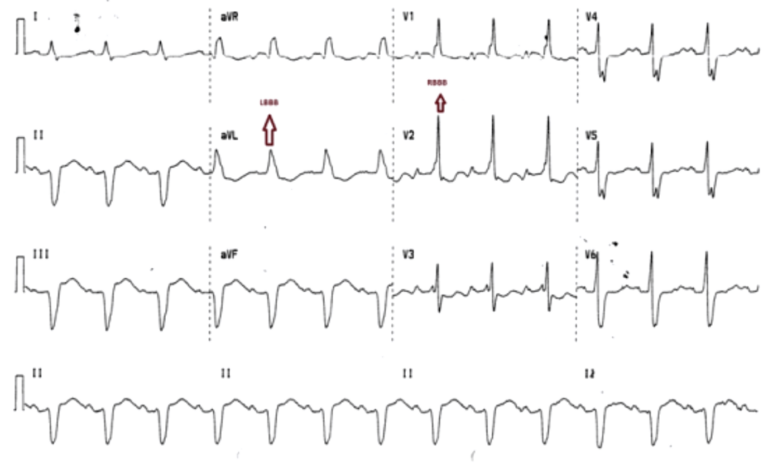 Masquerading Bundle Branch Block (MBBB) • LITFL • ECG Library