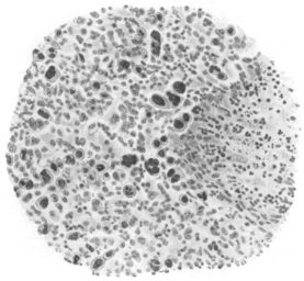 Reed-Sternberg cells • LITFL • Medical Eponym Library