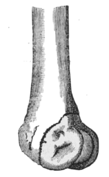 Hoffa fracture • LITFL • Medical Eponym Library