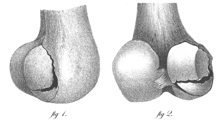 Hoffa fracture • LITFL • Medical Eponym Library