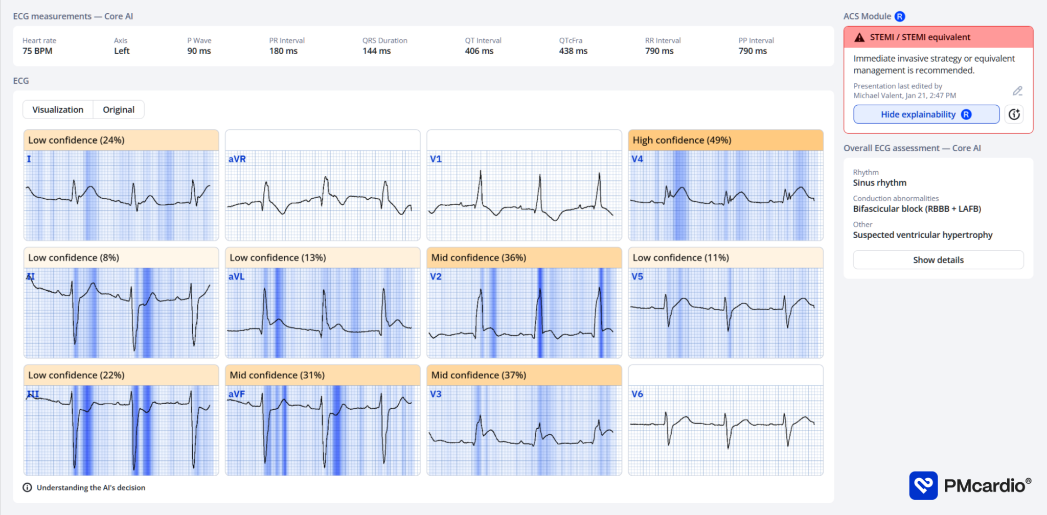 Activate or Wait - 009 • LITFL • Top 100 ECG