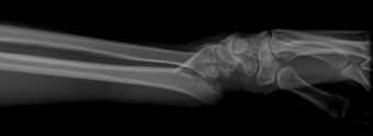 Barton fracture • LITFL • Medical Eponym Library