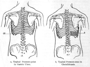 Ismar Isidor Boas • LITFL • Medical Eponym Library