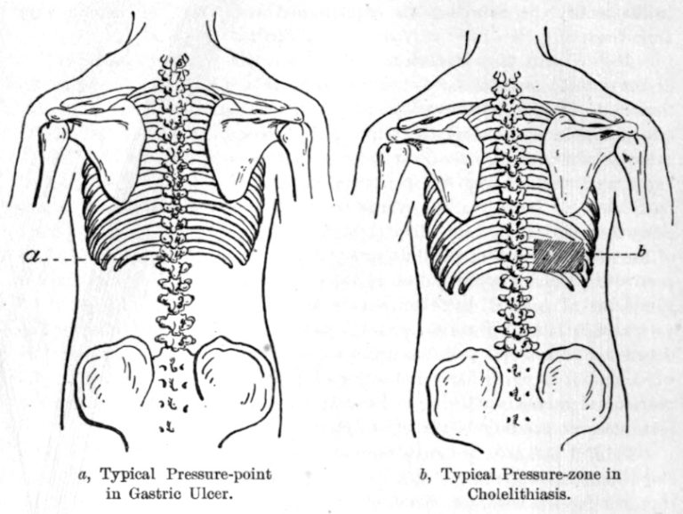Ismar Isidor Boas • LITFL • Medical Eponym Library