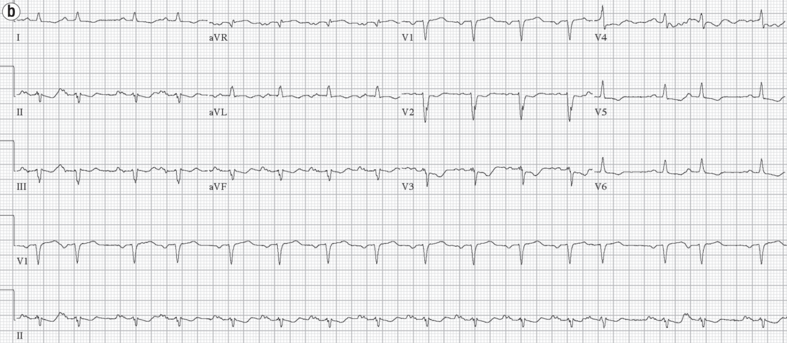 Kounis Syndrome • LITFL • ECG Library