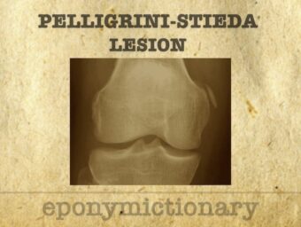 Stieda fracture Archives • LITFL