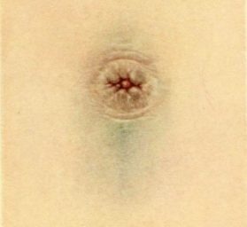 Thomas S. Cullen • LITFL • Medical Eponym Library