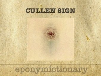 Simmonds-Thompson Test • LITFL • Medical Eponym Library