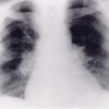 CXR eponyms in pulmonary embolism • LITFL • Medical Eponym Library