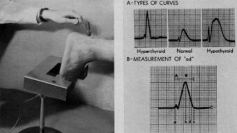 Woltman sign • LITFL • Medical Eponym Library