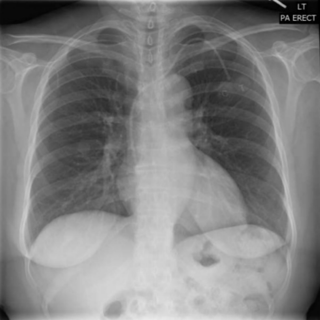 CXR Case 152 • LITFL • Chest X-ray Self-Assessment Quiz