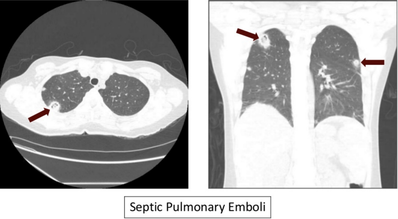 CXR Case 155 • LITFL • Chest X-ray Self-Assessment Quiz